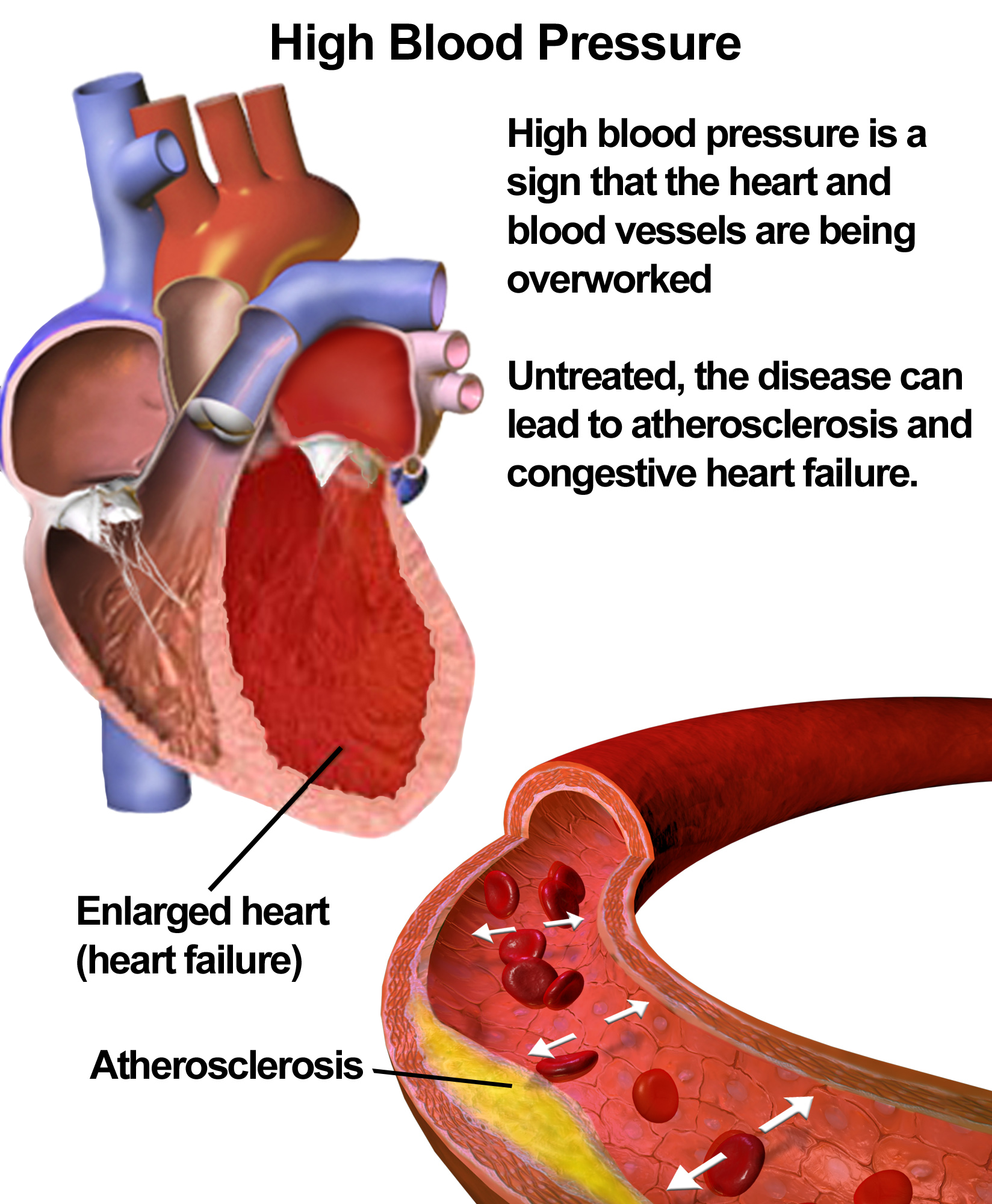 Perfect Treatment Of High Blood Pressure In Homeopathy In Pakistan